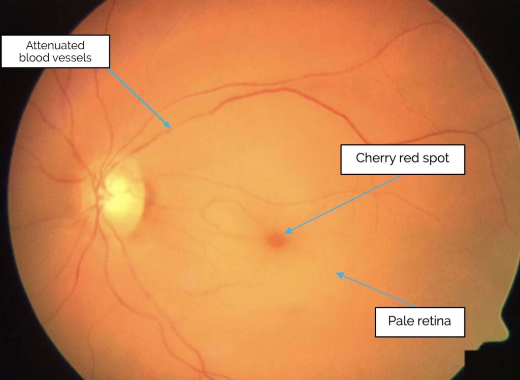 Vitreo-retinal disorders – Eyecare Nayonika
