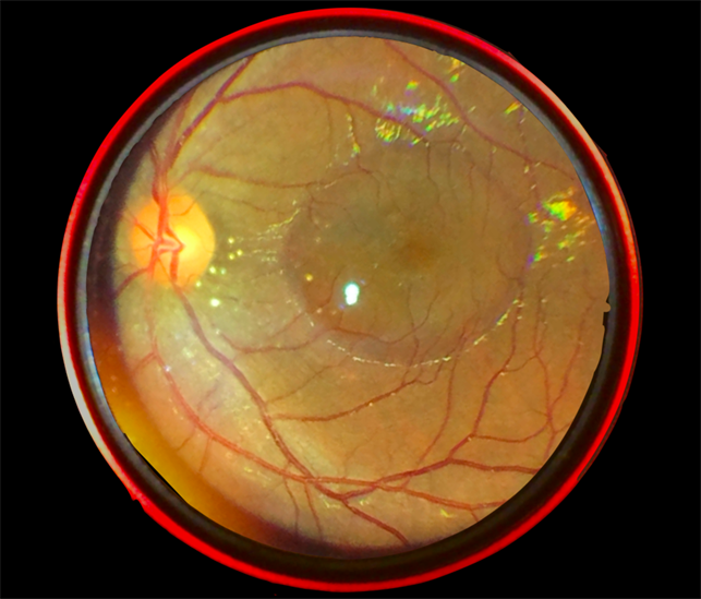 Vitreo-retinal disorders – Eyecare Nayonika