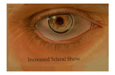 Oculoplasty – Eyecare Nayonika